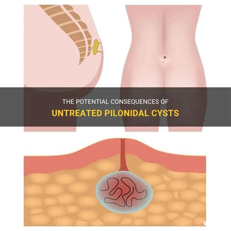 The Potential Consequences Of Untreated Pilonidal Cysts Medshun