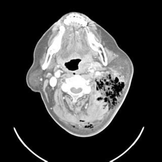 Pdf Necrotizing Fasciitis The Flesh Eating Bacterial Disease Of The Neck