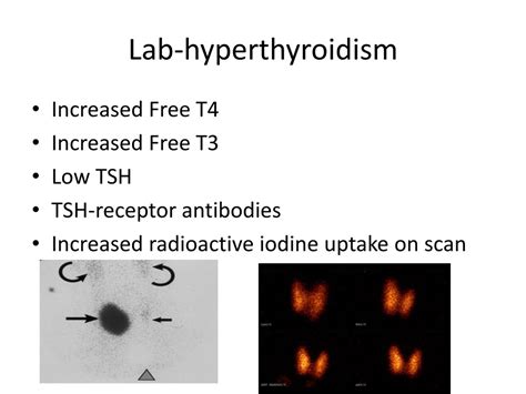 Ppt Thyroid Disorders Powerpoint Presentation Free Download Id1267285