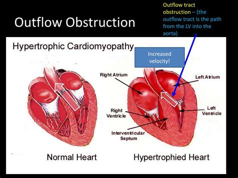 Ppt Abnormalities Of The Conduction System Elizabeth Dugan Edugan