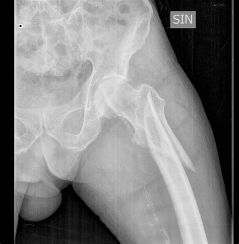 Ortho Femoral Bone Fracture X Rays And Treatment Flashcards Quizlet