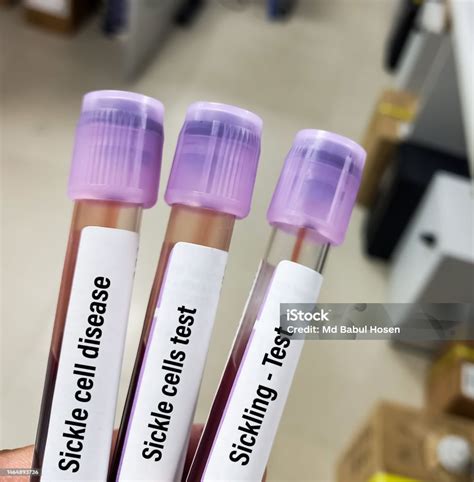 Blood Sample For Sickling Test Sickle Cell Disease Blood Test In Doctor
