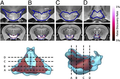 Details Of Alterations In The Hypothalamus Detected By Mri