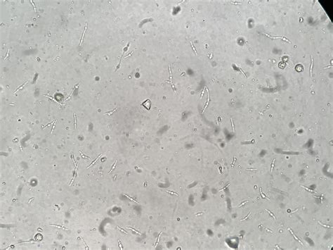 Urine Sediment Of The Month Bacterial Variant Forms Renal Fellow Network