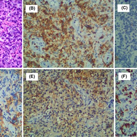 Ebv Positive B Cell Lymphoma Associated With A Primary Immune Disorder