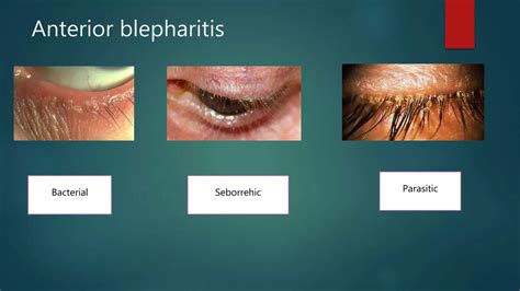 Blepharitis Ppt Pptx