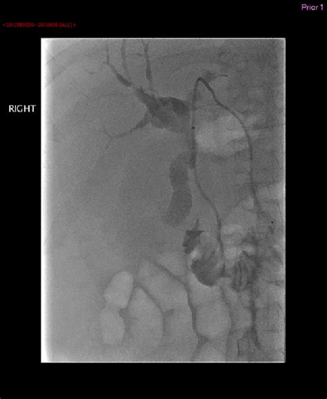 Figure 9 From Accessory Right Hepatic Artery Pseudoaneurysm Resulting In Biliary Obstruction