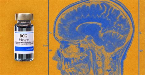 The Case For A Tuberculosis Vaccine To Prevent Dementia Science And Health