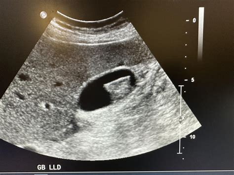 Square Gallstone On Ultrasound Rradiology
