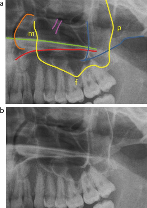Maxillary Sinus Anatomy Radiopaedia