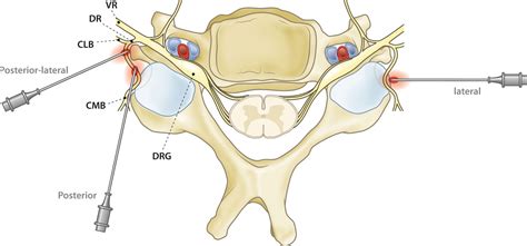 Endoscopic Facet Joint Denervation Rhizotomy With The