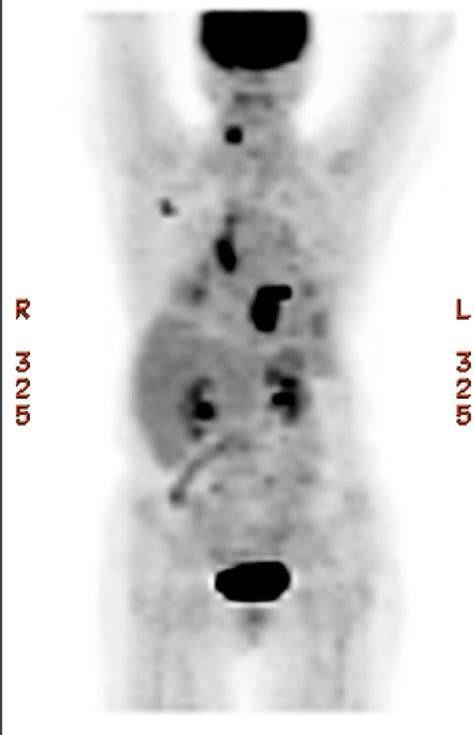 Figure 1 From Mobitz Ii Atrioventricular Block Following Intracardiac Radiation To The Right