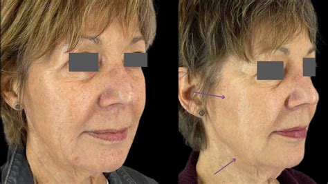Endolift Before During And After See Janes Real Results