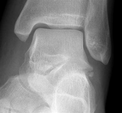 Talar Body Fracture The Bone School