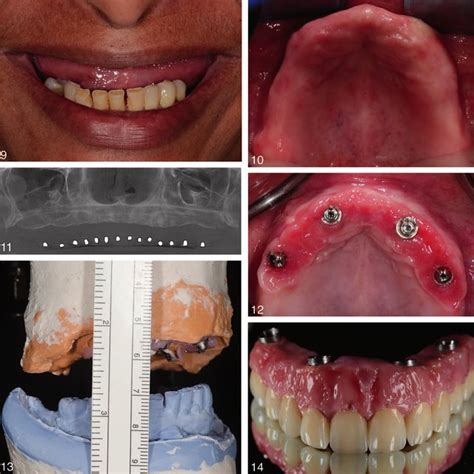 Pdf The “abcd” Implant Classification A Comprehensive Philosophy