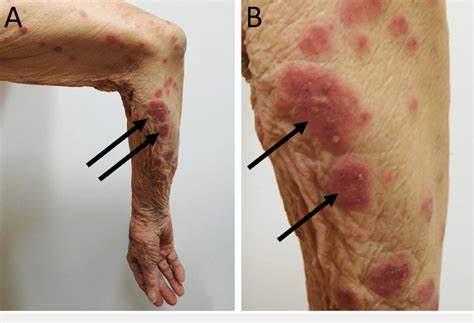 Bullous Cutaneous Leukocytoclastic Vasculitis On The Upper Extremities