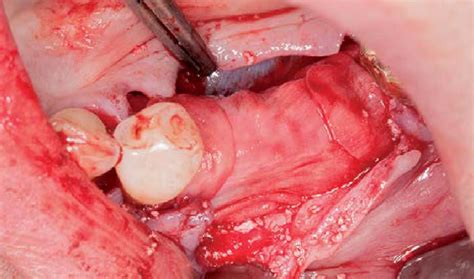 Vertical Defect In The Posterior Mandible 3 Teeth Gap Geistlich