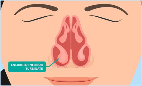 What Happens During Turbinate Reduction Indianapolis Sinus Center