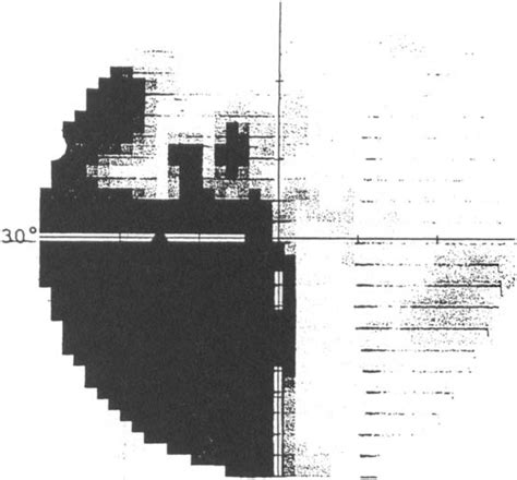 Visual Field Before Surgery Showing An Incomplete Bitemporal Download Scientific Diagram