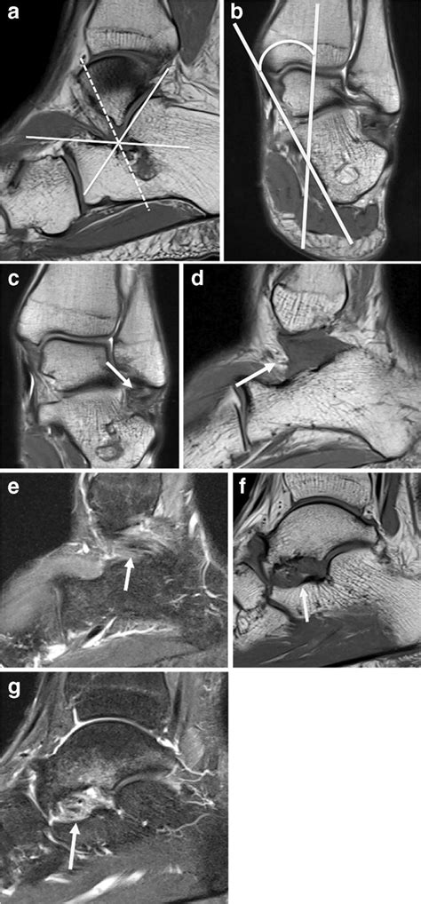 Extraarticular Lateral Hindfoot Impingement In A 17 Year Old Boy With