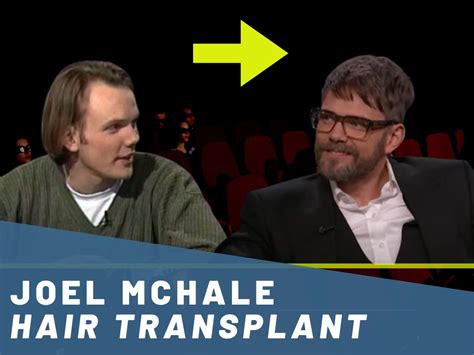 Joel McHale Hair Transplant Hair Loss Technical Analysis