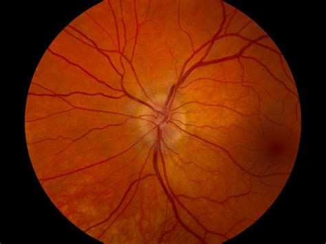 How To Grade Papilledema