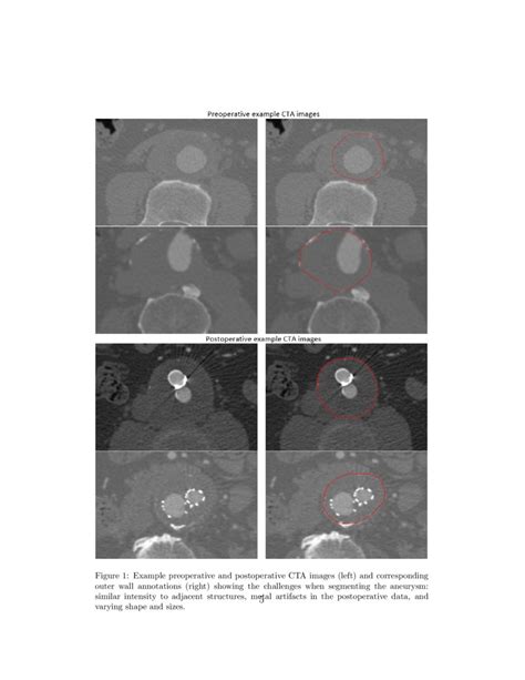 3d Convolutional Neural Network For Abdominal Aortic Aneurysm Segmentation Deepai