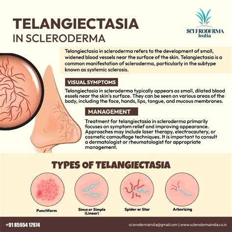 Scleroderma India On Linkedin Telangiectasia Sclerodermaindia