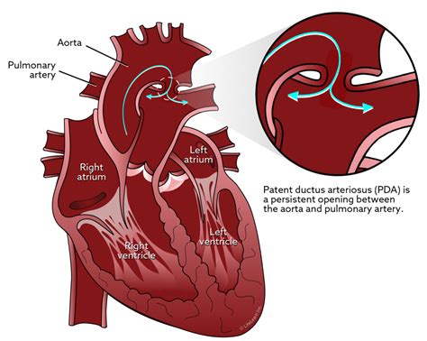 Ductus Arteriosus Pulmonary Atresia Mayo Clinic