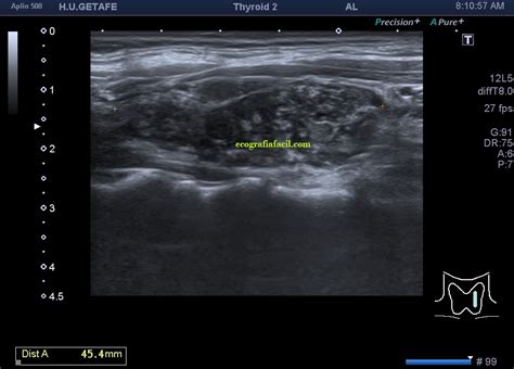 Tiroiditis Ecografía Fácil