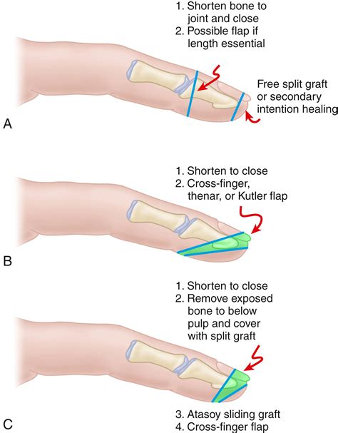 Amputations Of The Hand Clinical Tree