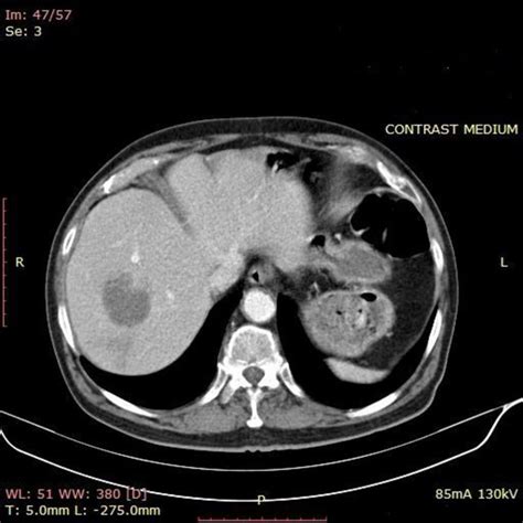 Immediate Post Ablational Ct Contrast Enhanced Imaging Of The Same