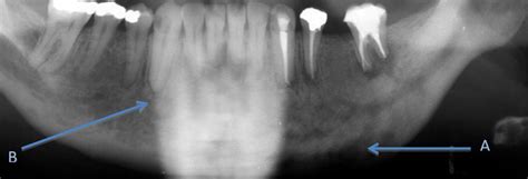 Diffuse Sclerosing Osteomyelitis