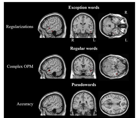 Figure 3 From The Role Of The Left Anterior Temporal Lobe For