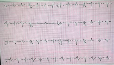 Solved ECG 2What Does The ECG Show Is This A Normal ECG Or Chegg Com