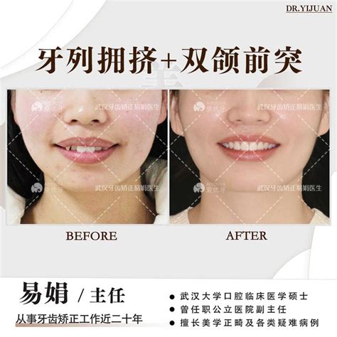 武汉牙齿矫正武汉正畸 『dryi美学案例 • 口腔问题复杂💥如何进行美学微笑设计 』 知乎