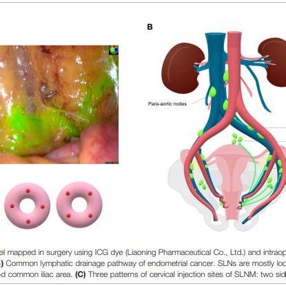 Sentinel Node Depiction After ICG Application Laparoscopic Sentinel Download Scientific