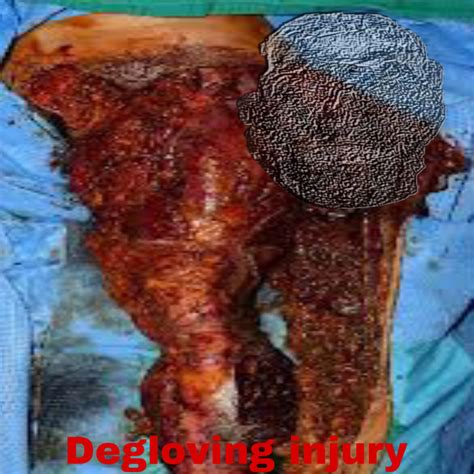 Degloving Injury Cxcx
