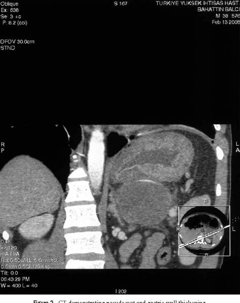 Figure 2 From Gastric Necrosis Due To Rapidly Growing Pancreatic Pseudocyst Semantic Scholar