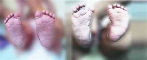 Metatarsus Adductus Treatment