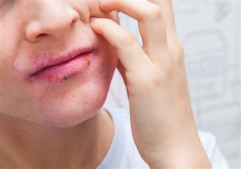 Dry Rash Around Mouth Treatment At Pamela Allis Blog