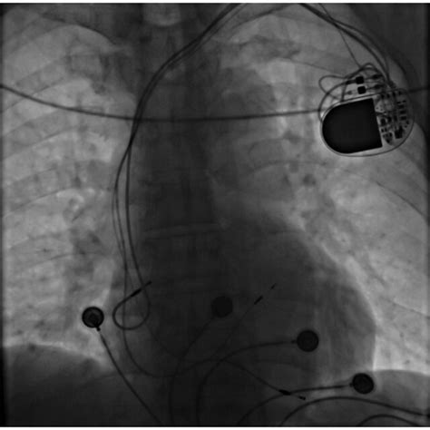 A Chest X Ray Shows The Position Of The Pacemaker And Electrode