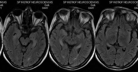 Neuroradiology Cases Limbic Encephalitis