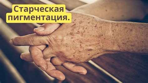 Старческая пигментация и весна Что нужно знать про возрастную пигментацию Youtube
