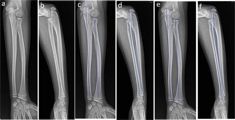 Anteriorposterior Ap And Lateral Lat Radiographs Of The Left Download Scientific Diagram