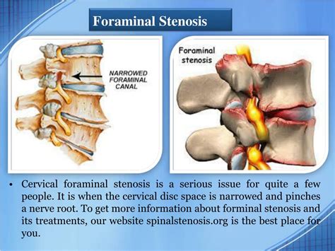Ppt Know In Detail About Spinal Stenosis Powerpoint Presentation