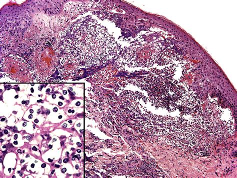 Iododerma Skin Biopsy Demonstrating An Interstitial Neutrophilic