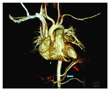 Thoracic Contrast Enhanced Computed Tomography Scan Cect Showing Download Scientific