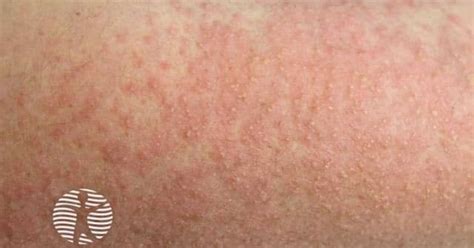 Polymorphic Light Eruption Image