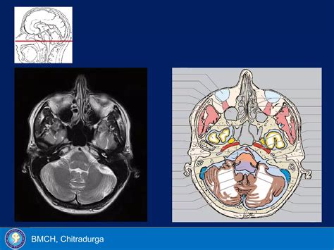 Cochlear Implant Imaging Ppsx